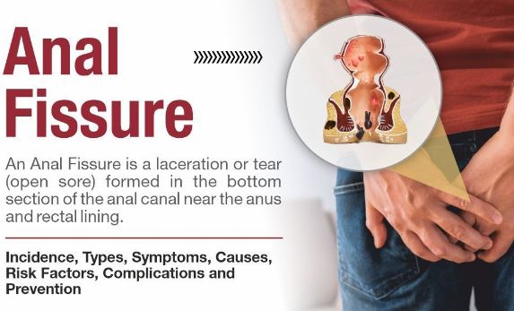 Homeopathy Treatment For Anorectal Fissure