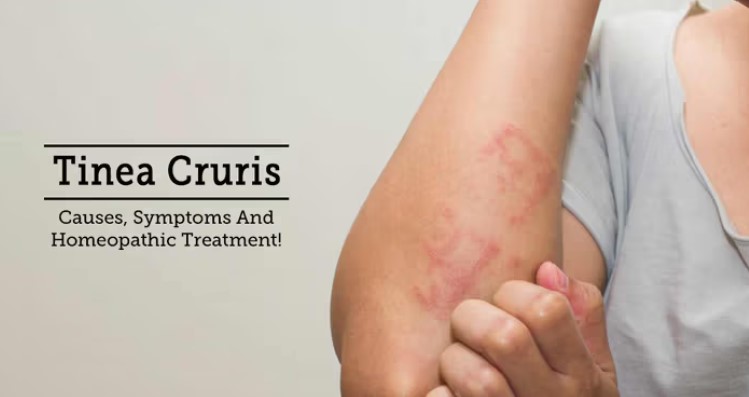 Homeopathy Treatment for Jock Itch or Tinea Cruris